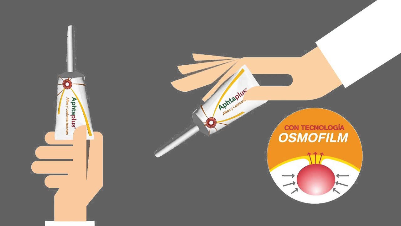 Aphtaplus: alivio y tratamiento eficaz de las aftas bucales - YouTube