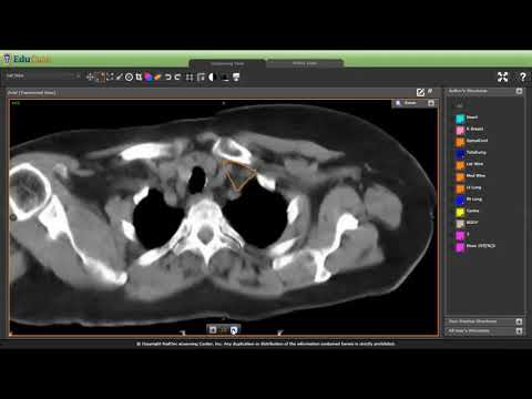 Breast Nodal Volume Delineation