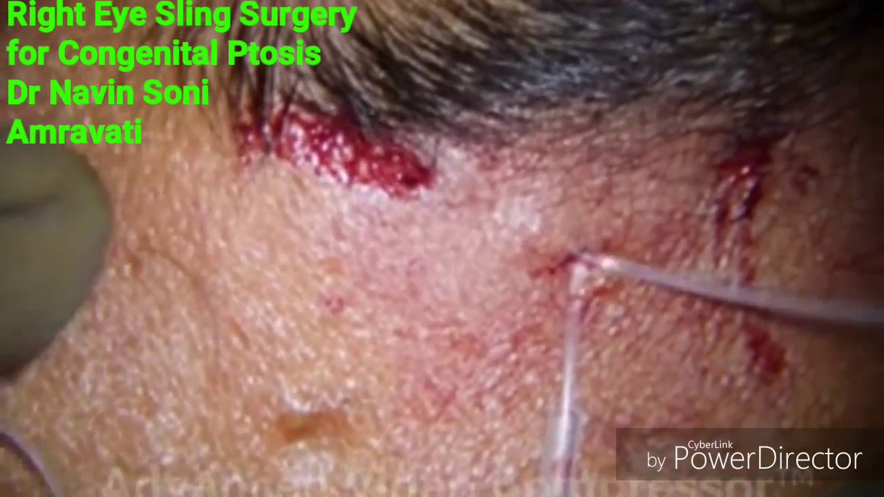 Ptosis Surgery-Sling - YouTube
