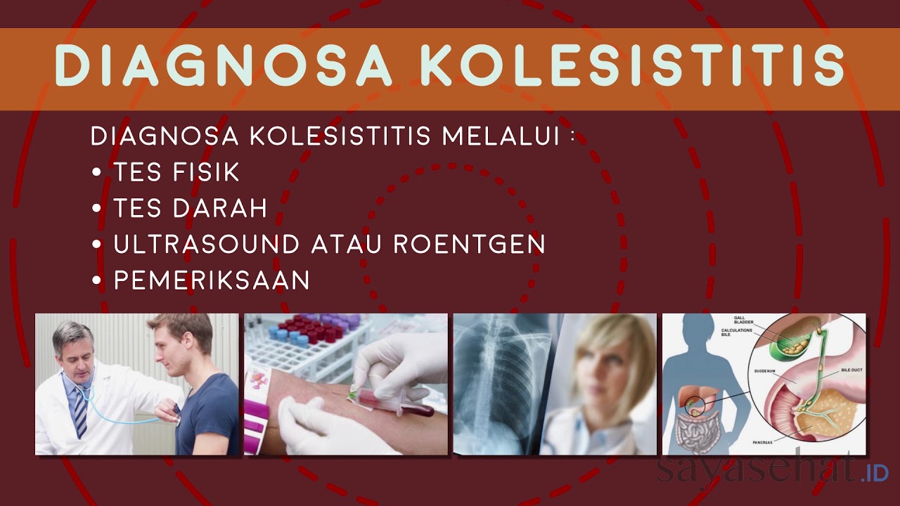 Kolesistitis - YouTube