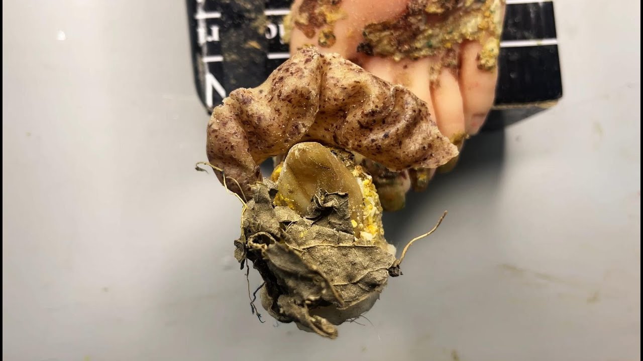 CUT Ingrown Toenails, Toenails with Maggots, Fungal Toenails ...