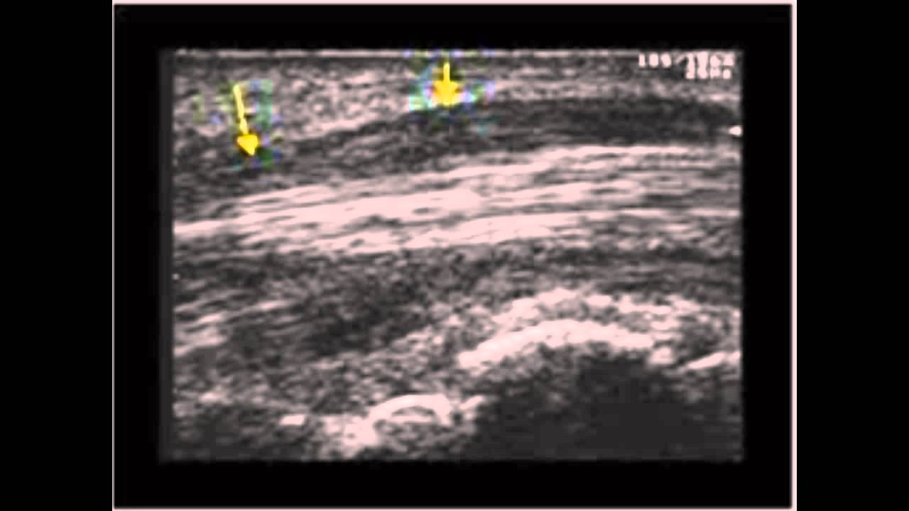 Ultrasound Guided Median Nerve Release - YouTube