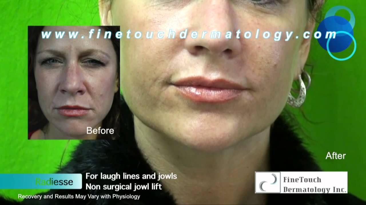 Nonsurgical Jowl Lift with Radiesse: Before and After Facial ...