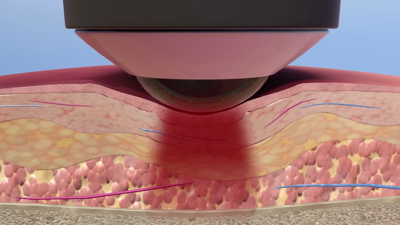 Deep Tissue Laser Therapy Animation - YouTube