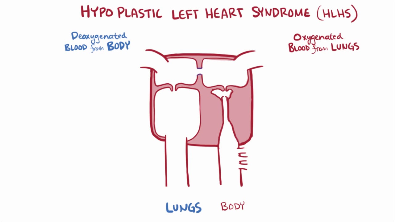 Hypoplastic left heart syndrome HLHS causes, symptoms & pathology - YouTube