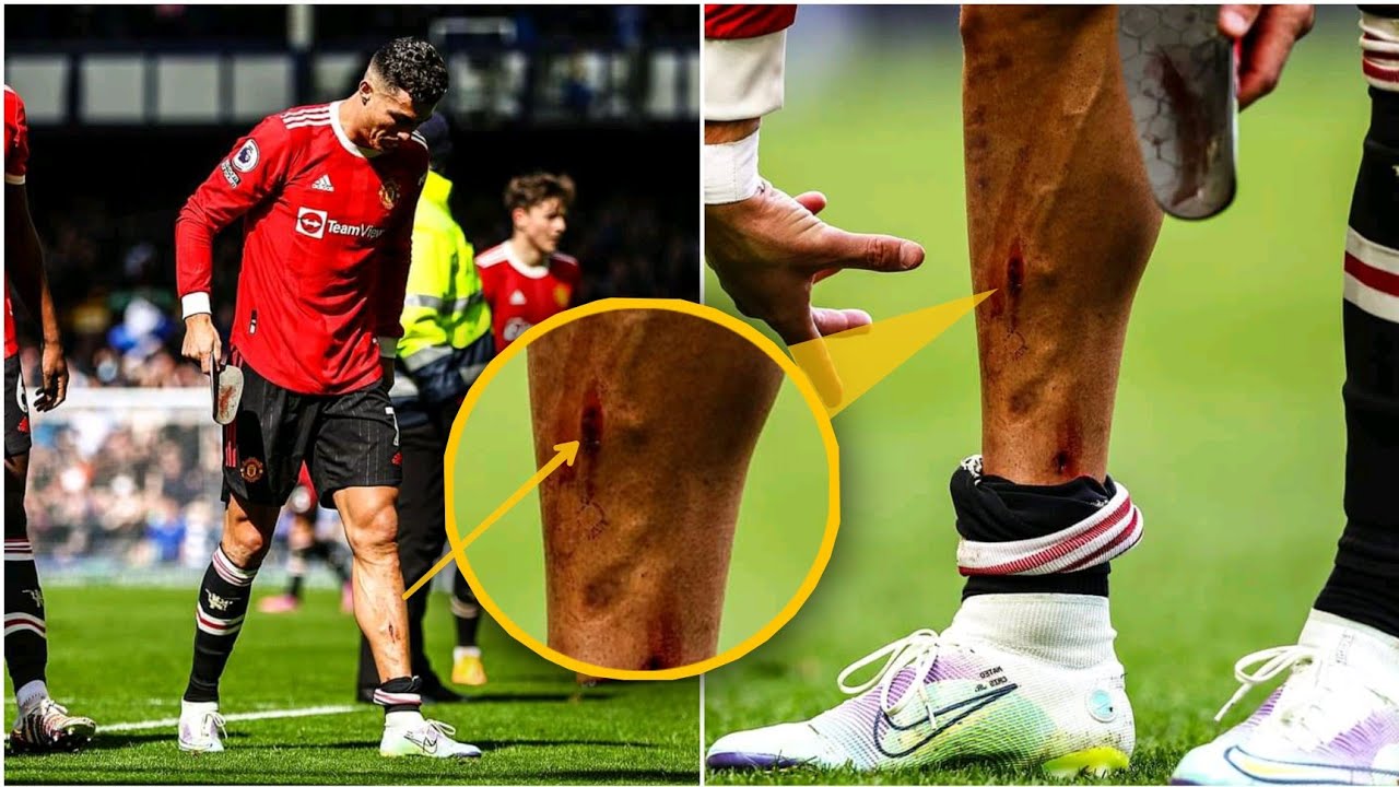 Ronaldo HORROR cut leg Vs Everton - YouTube