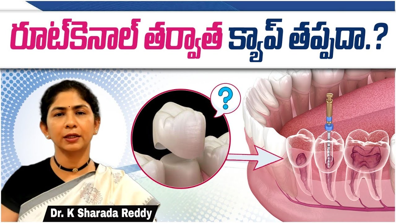 RCT తర్వాత క్యాప్ తప్పదా.? || Is Cap Necessary After Root Canal? || Dr ...