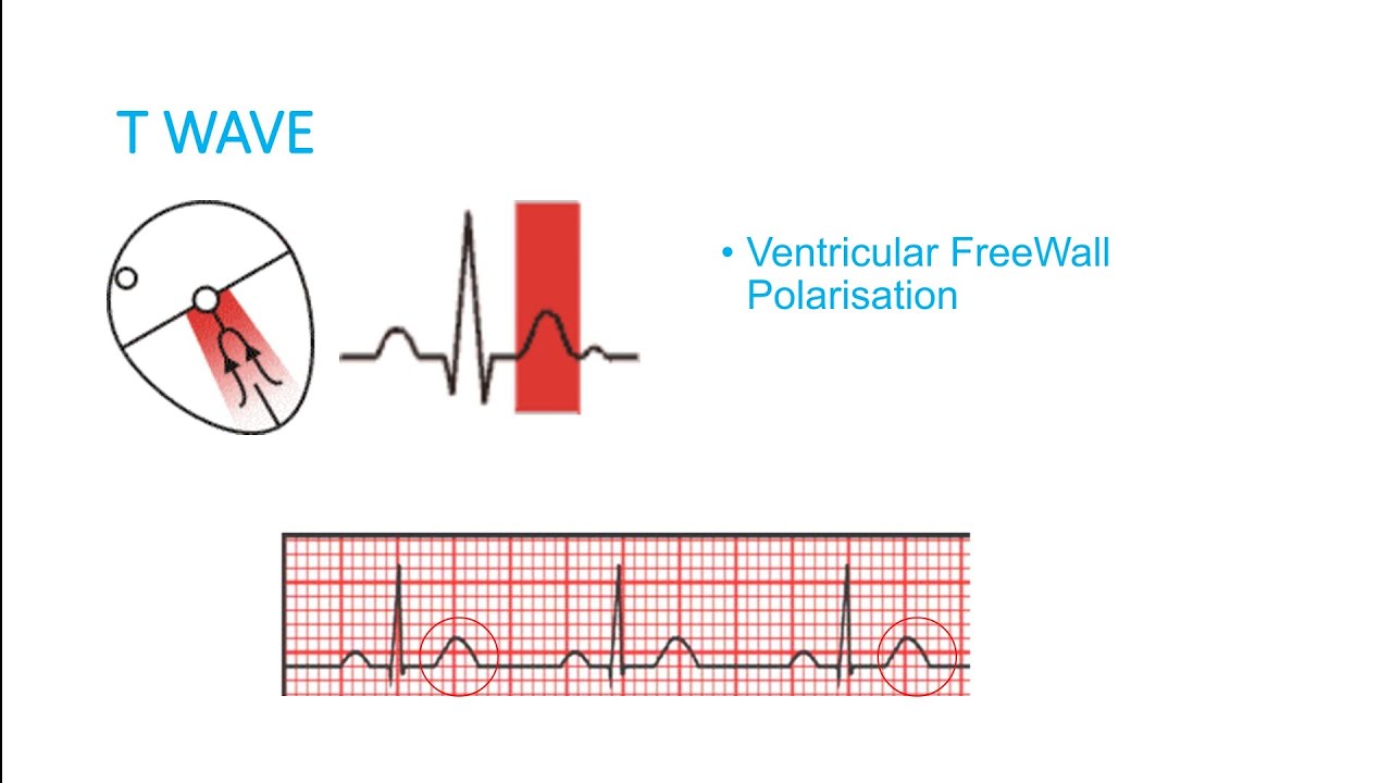Mastering ECG, T wave by Dr Gireesh Kumar K P - YouTube