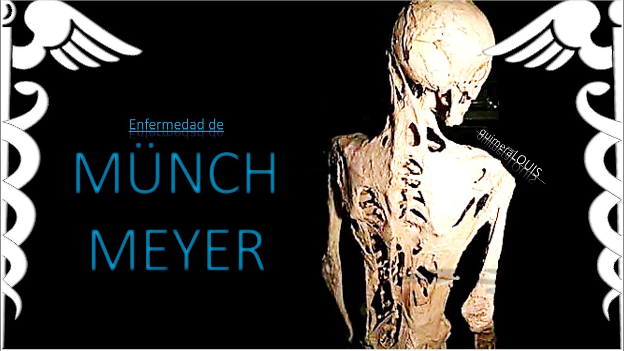 Enfermedad de Münchmeyer | Medicina | quimeraLOUIS - YouTube