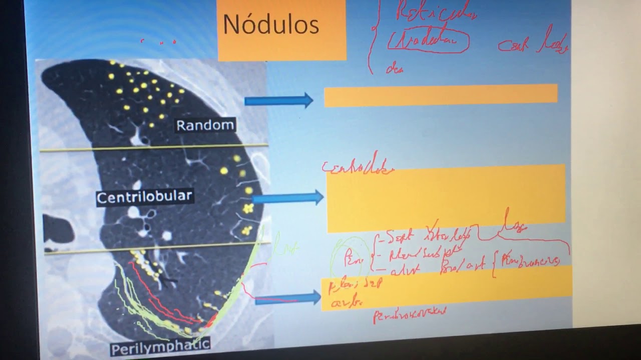 Lección 5. Patron Nodular. Tomografía Computarizada de Torax - YouTube