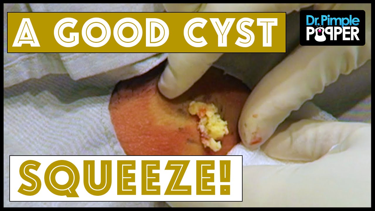 A really BIG Cyst SQUEEZE on the Neck - YouTube