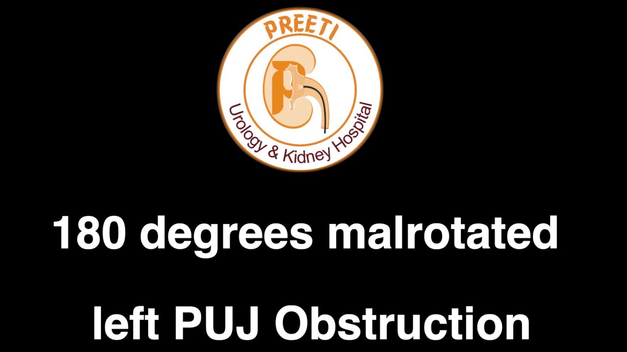 180 degrees malrotated left PUJ Obstruction - YouTube