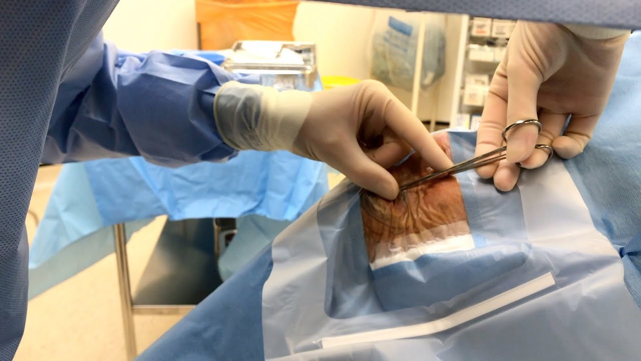 Deconstructing cataract surgery 10 - Setting Up - YouTube