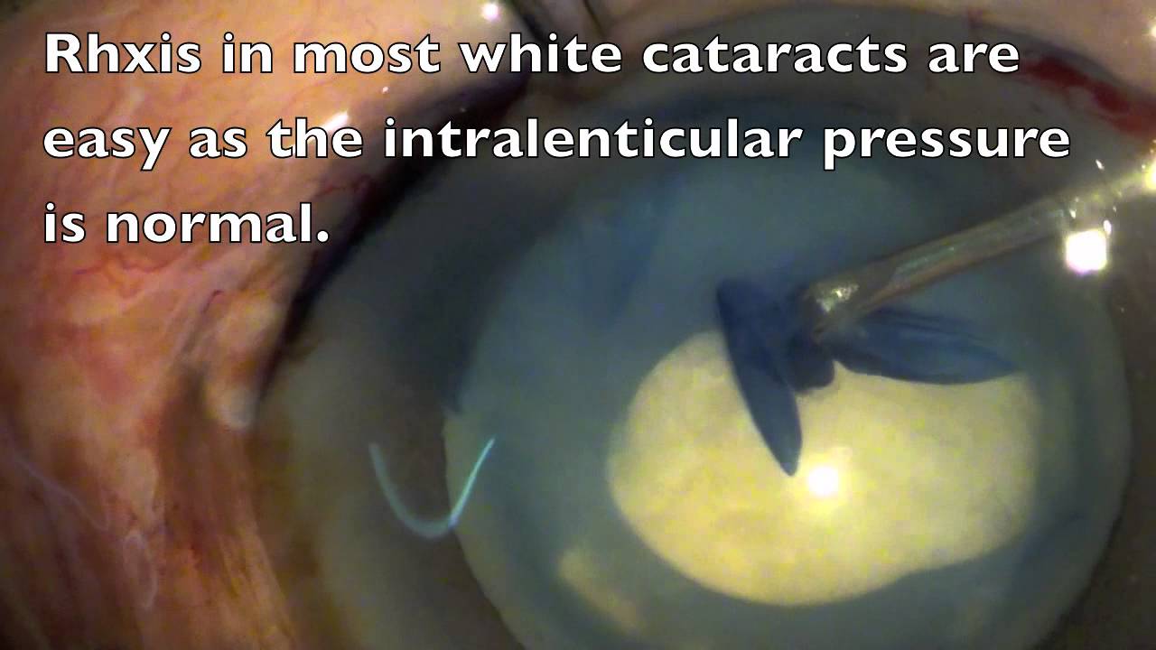 white cataract rhexis - YouTube