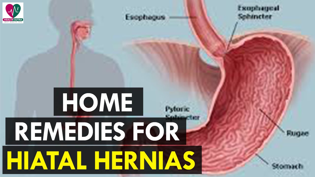 Home Remedies for Hiatal Hernias - Health Sutra - YouTube