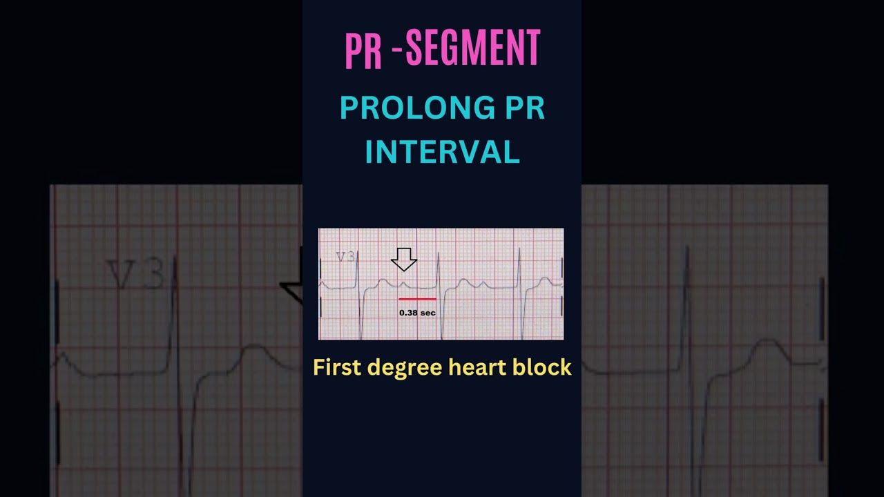 ECG FUNDAMENTALS FOR BEGINNERS- PR INTERVAL #shorts - Go IT