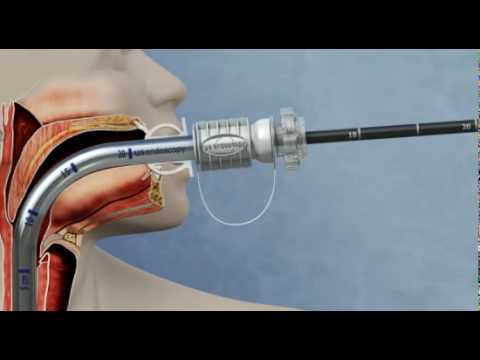 Food bolus retrieval using the GUARDUS™ Overtube and TALON™ Grasping Device