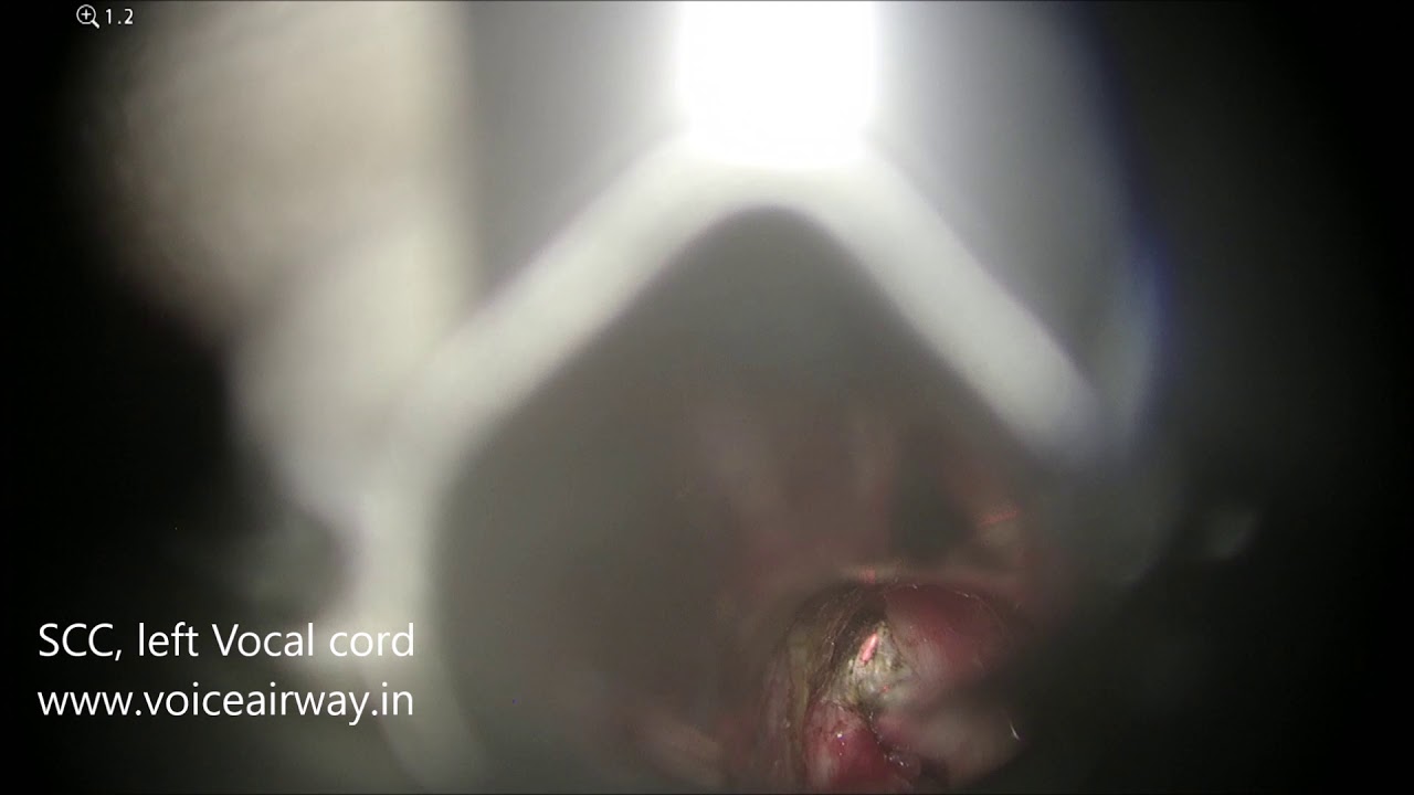 Vocal Cord(SCC) T1a-subepithelial cordectomy - YouTube