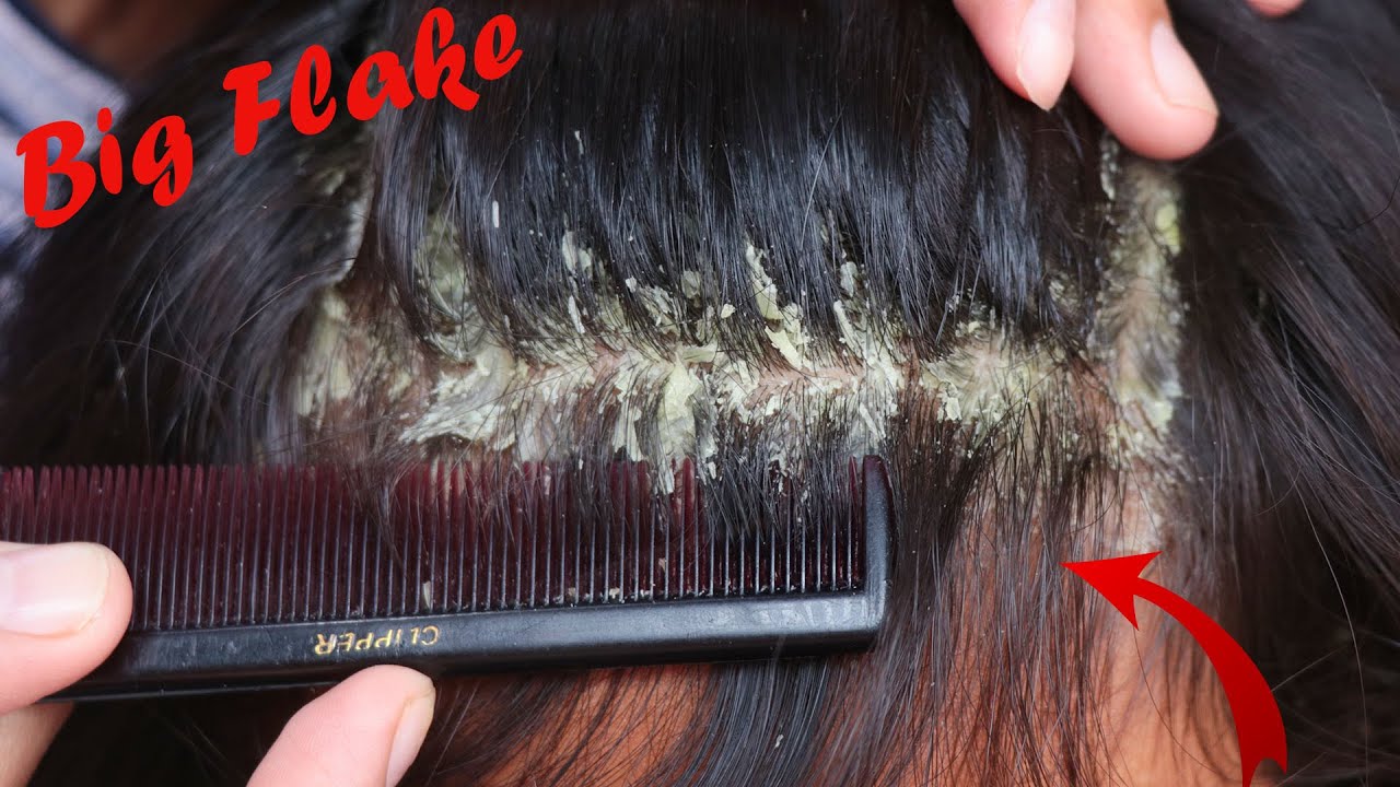 Scalp Scratching Dandruff with Comb | Dandruff Removal #650 - YouTube