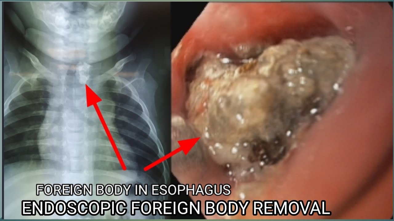 Endoscopic Foreign Body Removal concrete stone #BD_ENDOSCOPY - YouTube