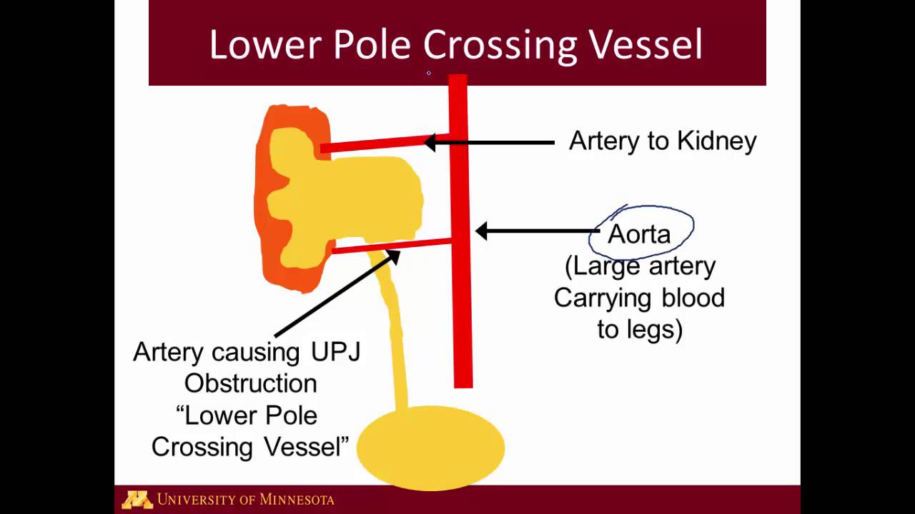 UPJ Obstruction - What is it - YouTube