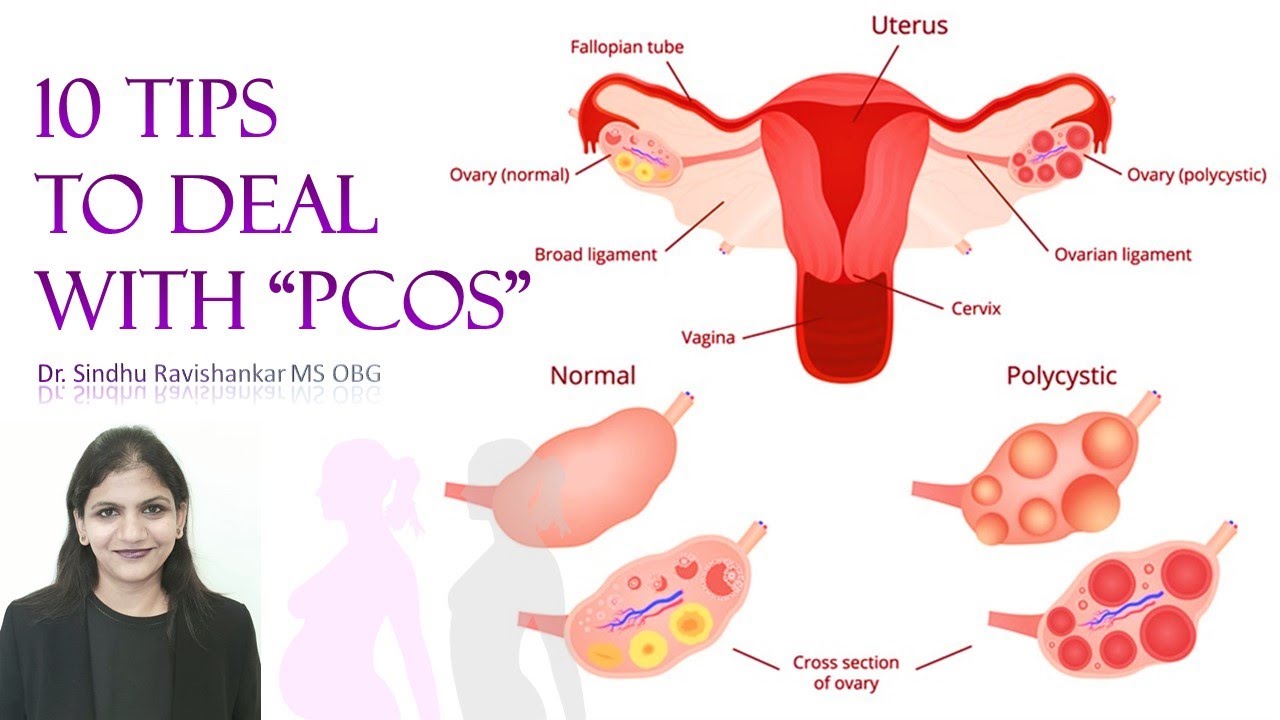 TIPS TO DEAL WITH POLYCYSTIC OVARIES: What is PCOS, Complications of ...
