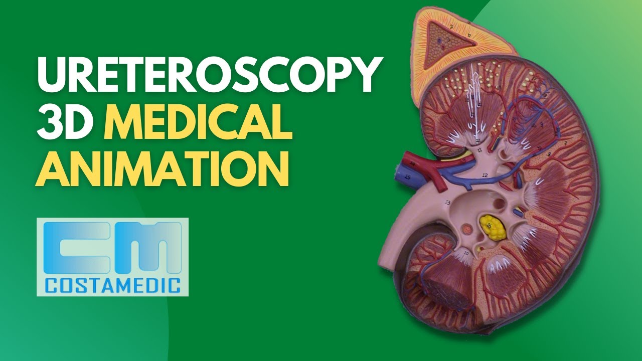 Ureteroscopy 3d animation - YouTube