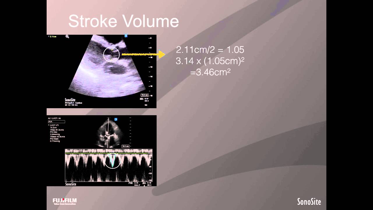 Webinar: Resuscitative Echo: Visual Assessment & Doppler Measurements - YouTube