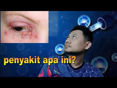 APAKAH MATA KABUR KARENA HERPES BISA NORMAL? HERPES DI MATA BISA MENYEBABKAN KEBUTAAN!!