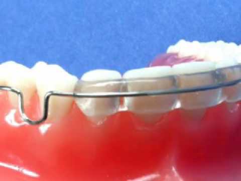 Acrylic Covered Labial Bow Description - YouTube