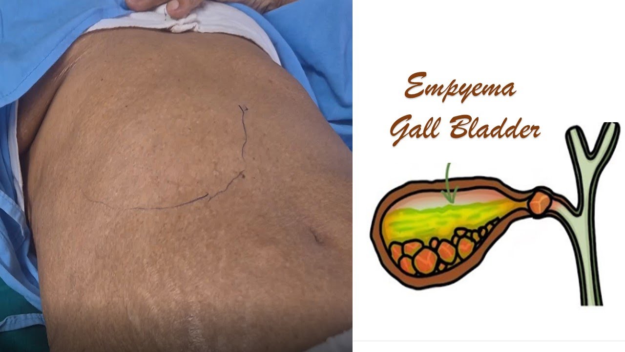 Open Cholecystostomy Under Local Anaesthesia - YouTube
