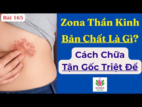 Zona Thần Kinh (Bệnh Giời Leo) Bản Chất Là Gì? Cách Điều Trị Tận Gốc Tránh Biến Chứng Nguy Hiểm