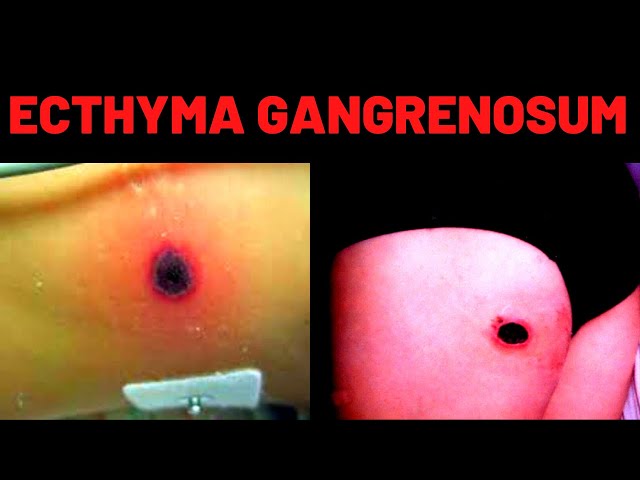 Ecthyma Face