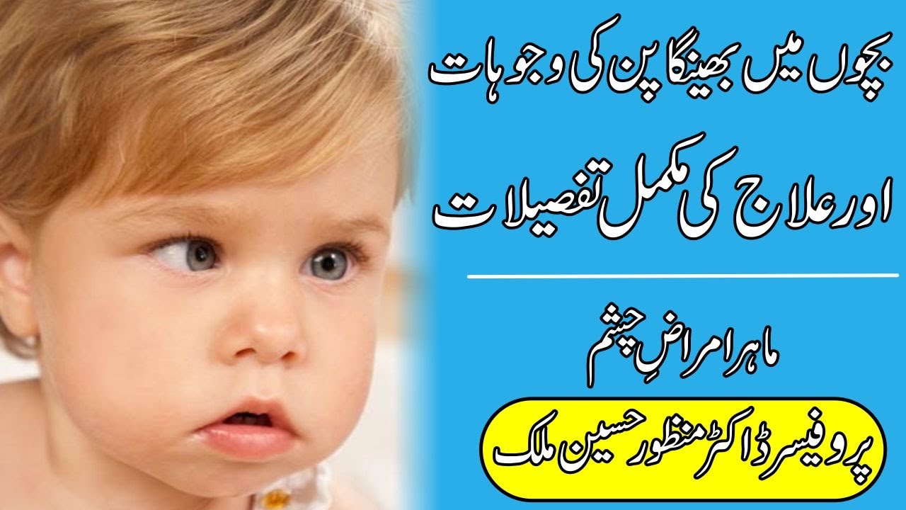 Squint (Bhengapan) treatment without surgery | Lazy eye exercise | Urdu ...