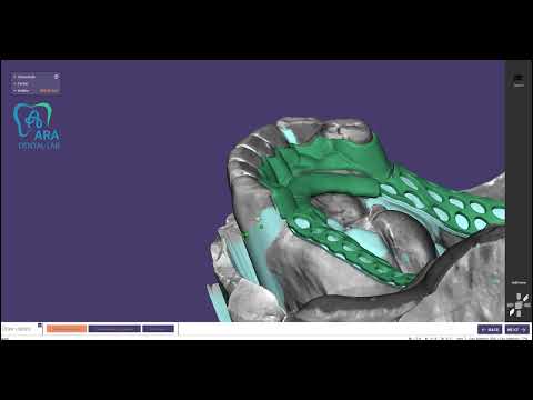 linguoplate case partial design - YouTube