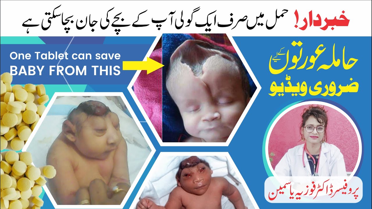 Baby Without Head Findings Of Anencephaly:حمل میں صرف ایک گولی | By Dr ...