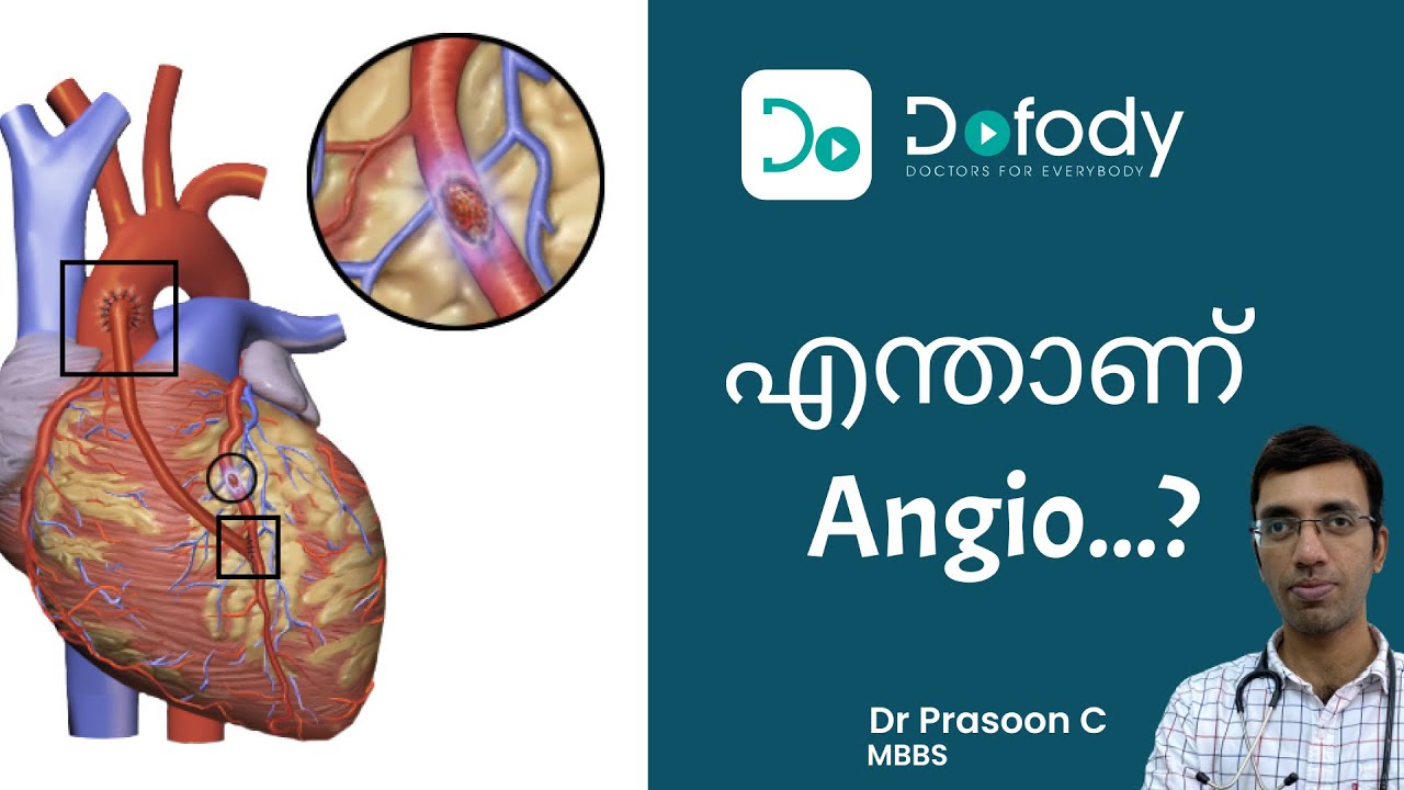 Bypass വേണോ? Angio വേണോ?| Angiogram vs Angioplasty vs Bypass Surgery ...