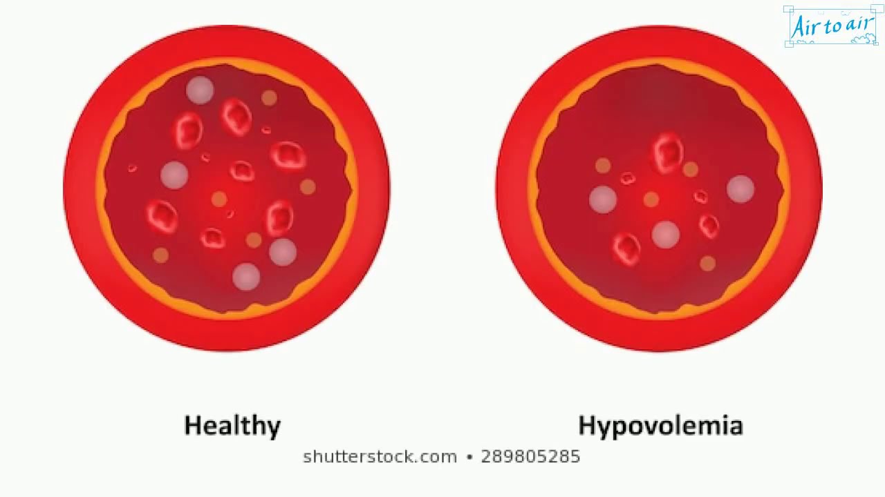 hypovolemia - YouTube