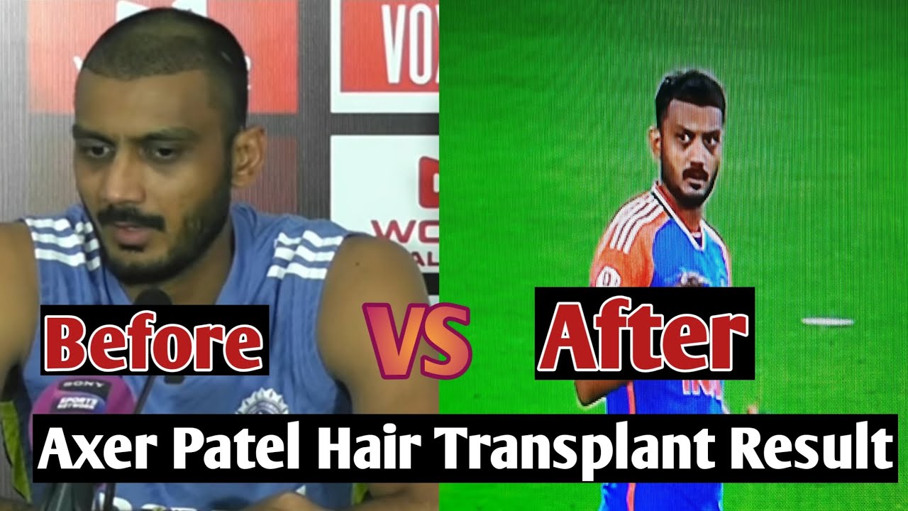 Axar patel hair transplant result | Axer patel 4 month hair transplant ...