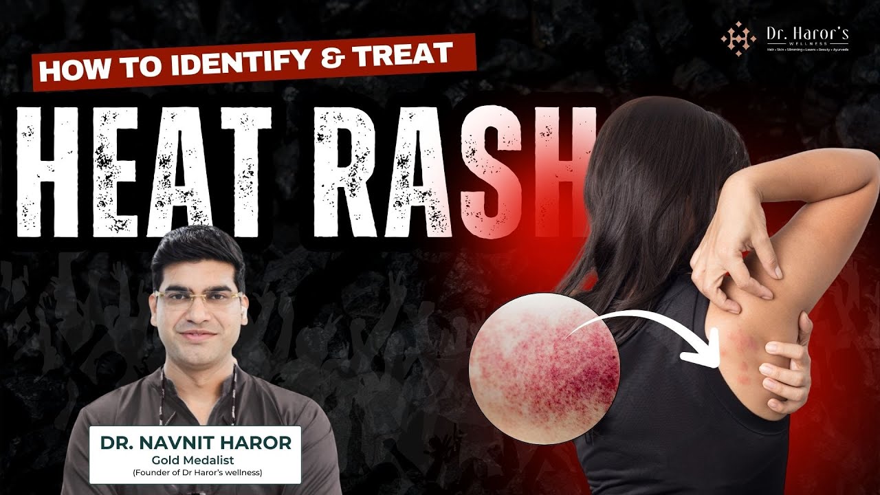 Heat Rashes? Here's What You Should Do |Heat Rashes in Summer # ...