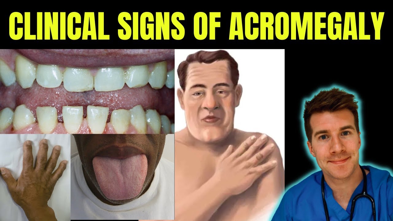 Acromegaly Teeth