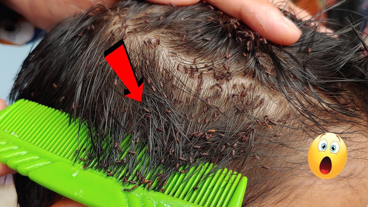 This boy full of giant lice on head - Lice combing - YouTube
