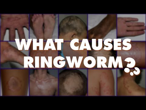 What Does Ringworm Look Like When It First Starts Out