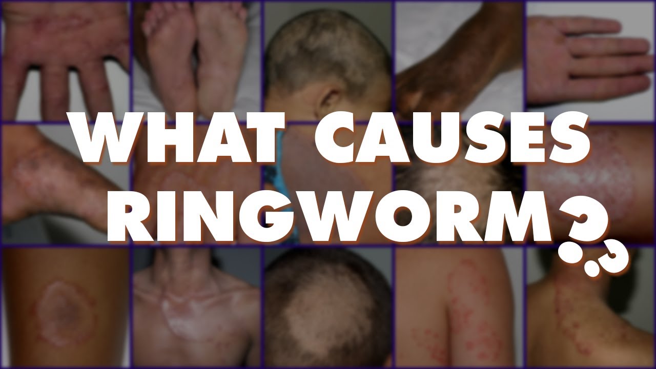 Ringworm- Dr Explains- Signs Symptoms Pictures - YouTube