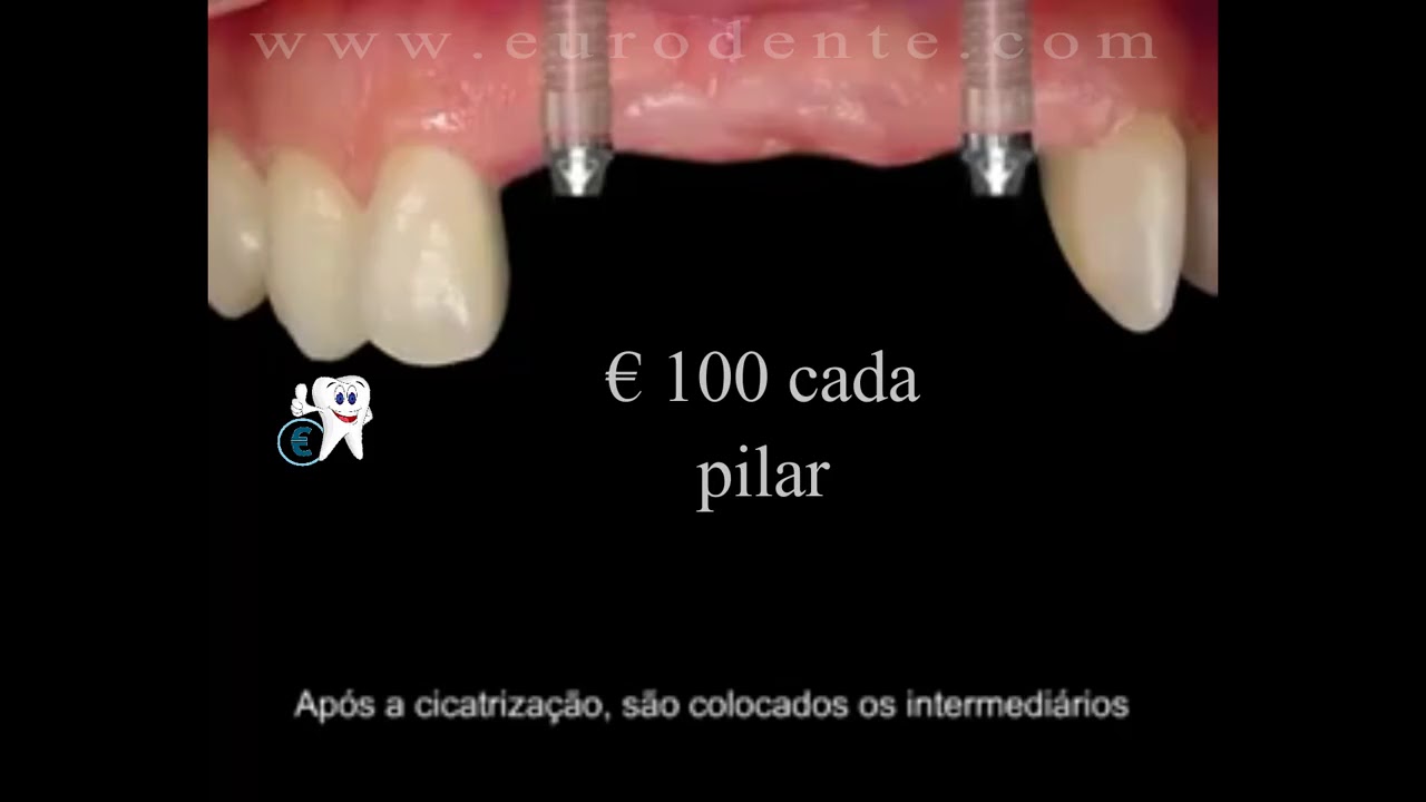 Ponte dentária fixa em implantes - YouTube