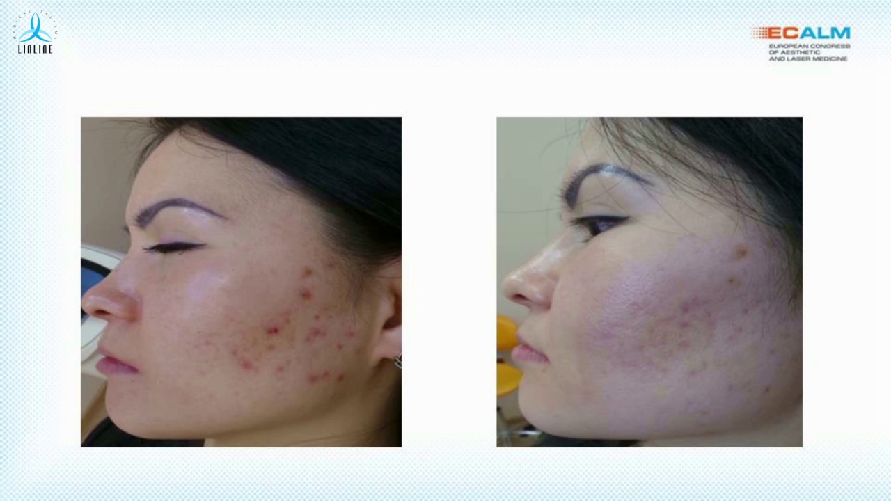 Modern Laser Technology RecoSMA and Isotretinoin for the Treatment of ...
