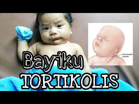 Kepala anak miring??AWAS TORTIKOLIS!!!! - YouTube