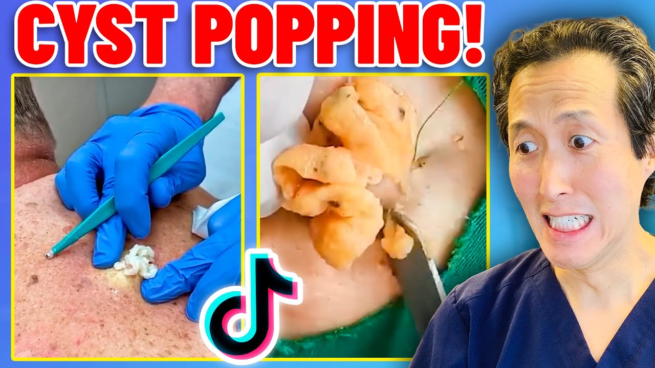 Doctor Reacts to Extreme CYST & Pimple Popping Videos! - YouTube