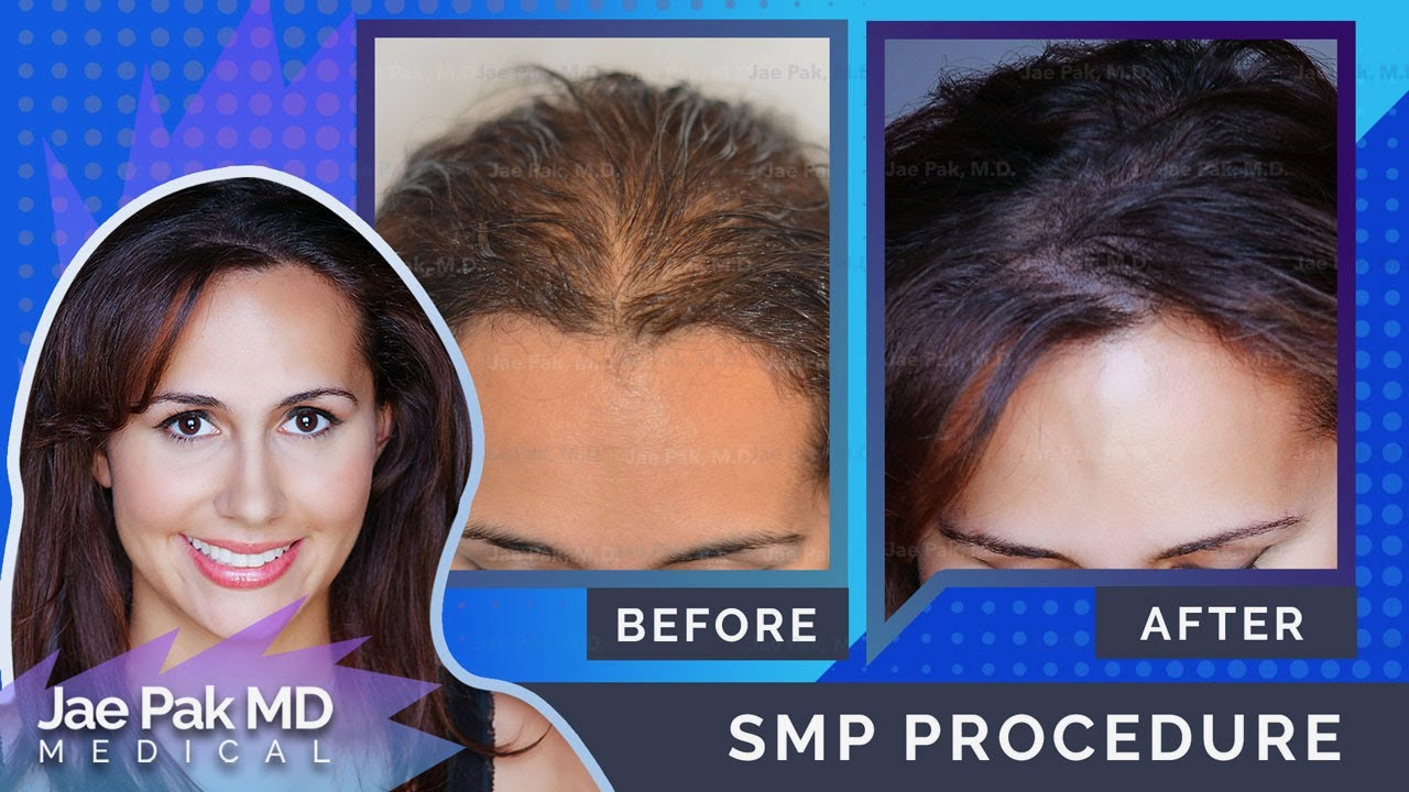 Scalp Micropigmentation for Women | Jae Pak MD Medical - YouTube