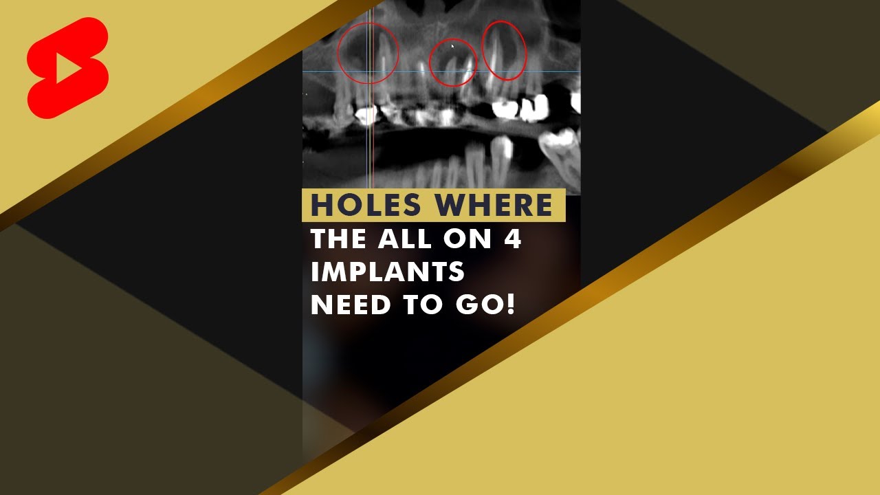 Unveiling the Secret to Successful All on 4 Dental Implants! - YouTube